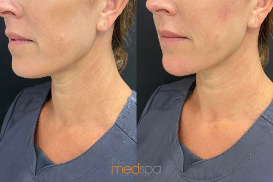 Juvéderm Volux XC in Smyrna Beach | Med Spa NSB