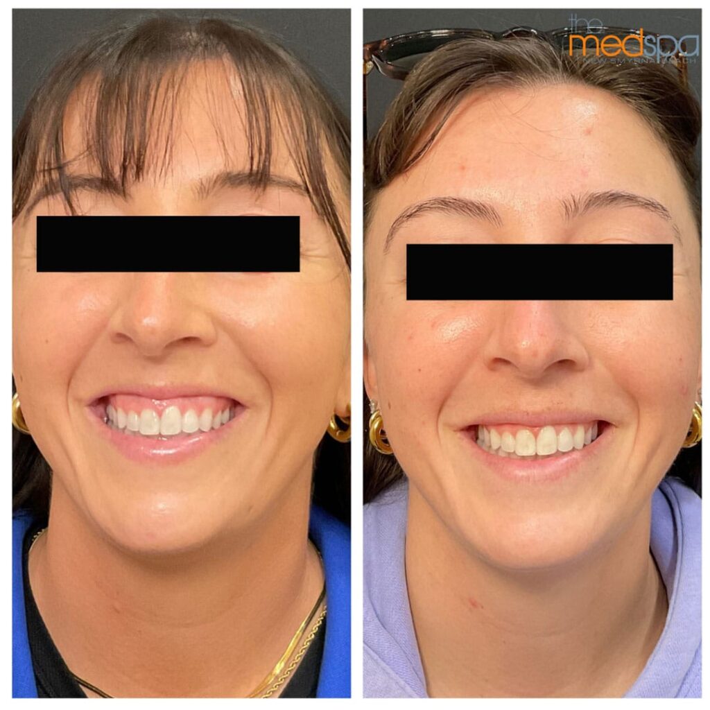 Botox in New Smyrna Beach | The Med Spa NSB