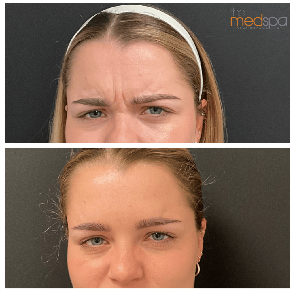 Botox in New Smyrna Beach | The Med Spa NSB