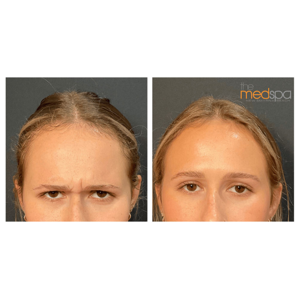 Botox in New Smyrna Beach | The Med Spa NSB