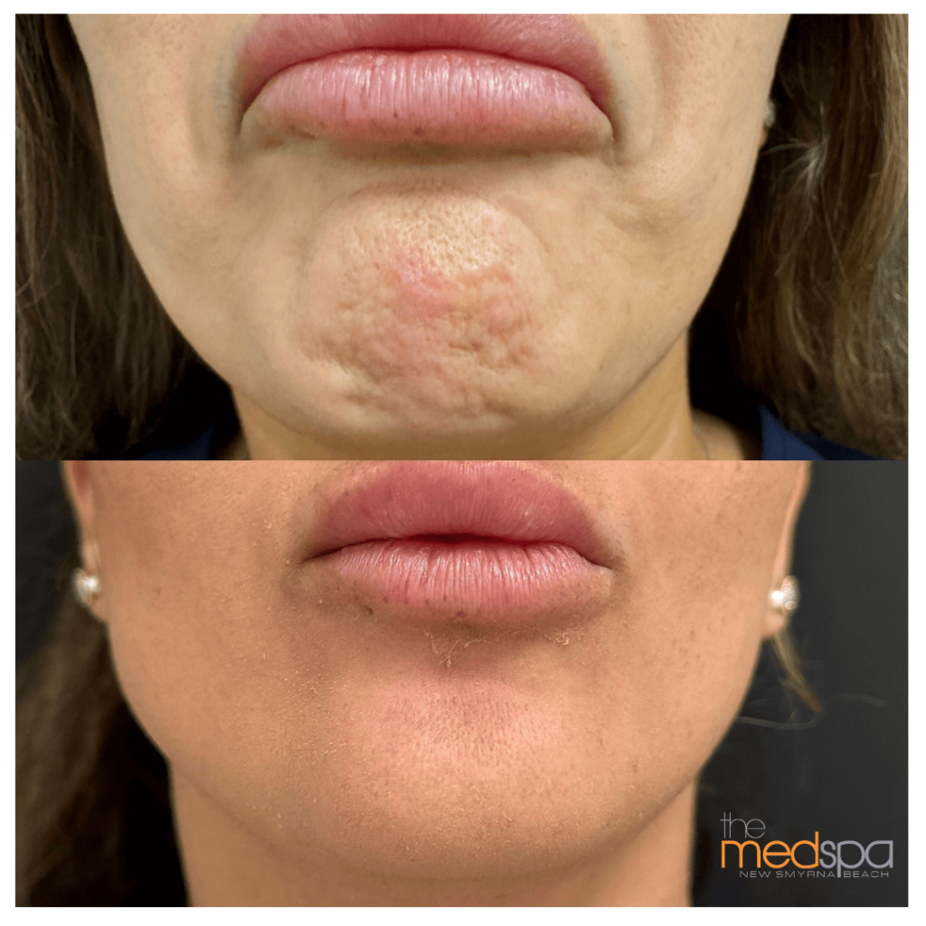 Botox in New Smyrna Beach | The Med Spa NSB